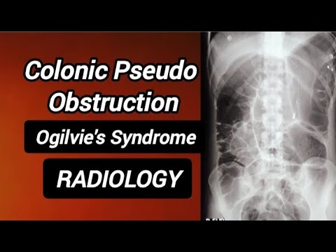 Colonic Pseudo obstruction # Ogilvies´s Syndrome # Radiology - YouTube