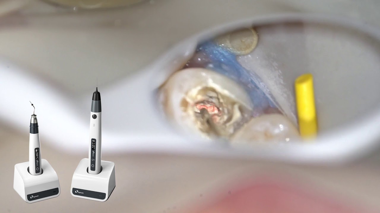 Eighteeth Obturation System - Clinical Case By Dr.Toygan Bora - YouTube