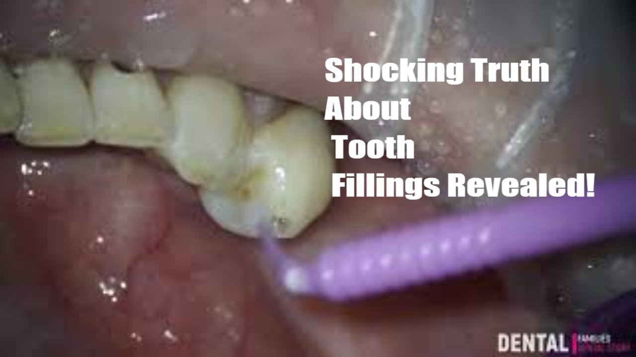 Shocking Truth About Tooth Fillings Revealed! #dentist #teeth #dental # ...