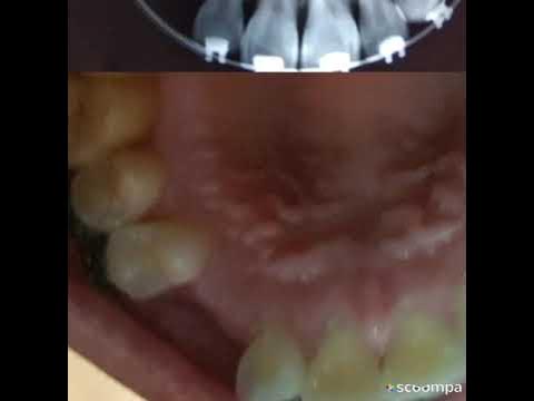 Surgical exposure of impacted canine with open window technique. Before ...