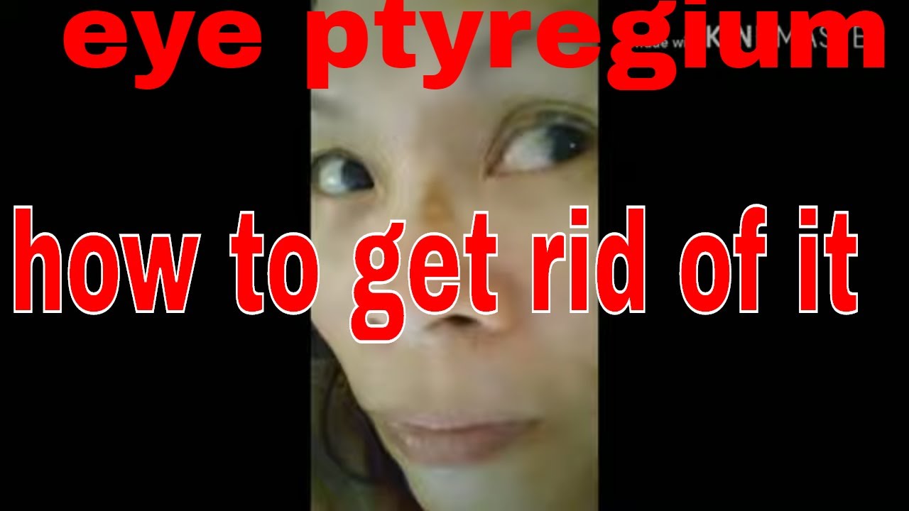 all about vision||eye Ptyregium - YouTube
