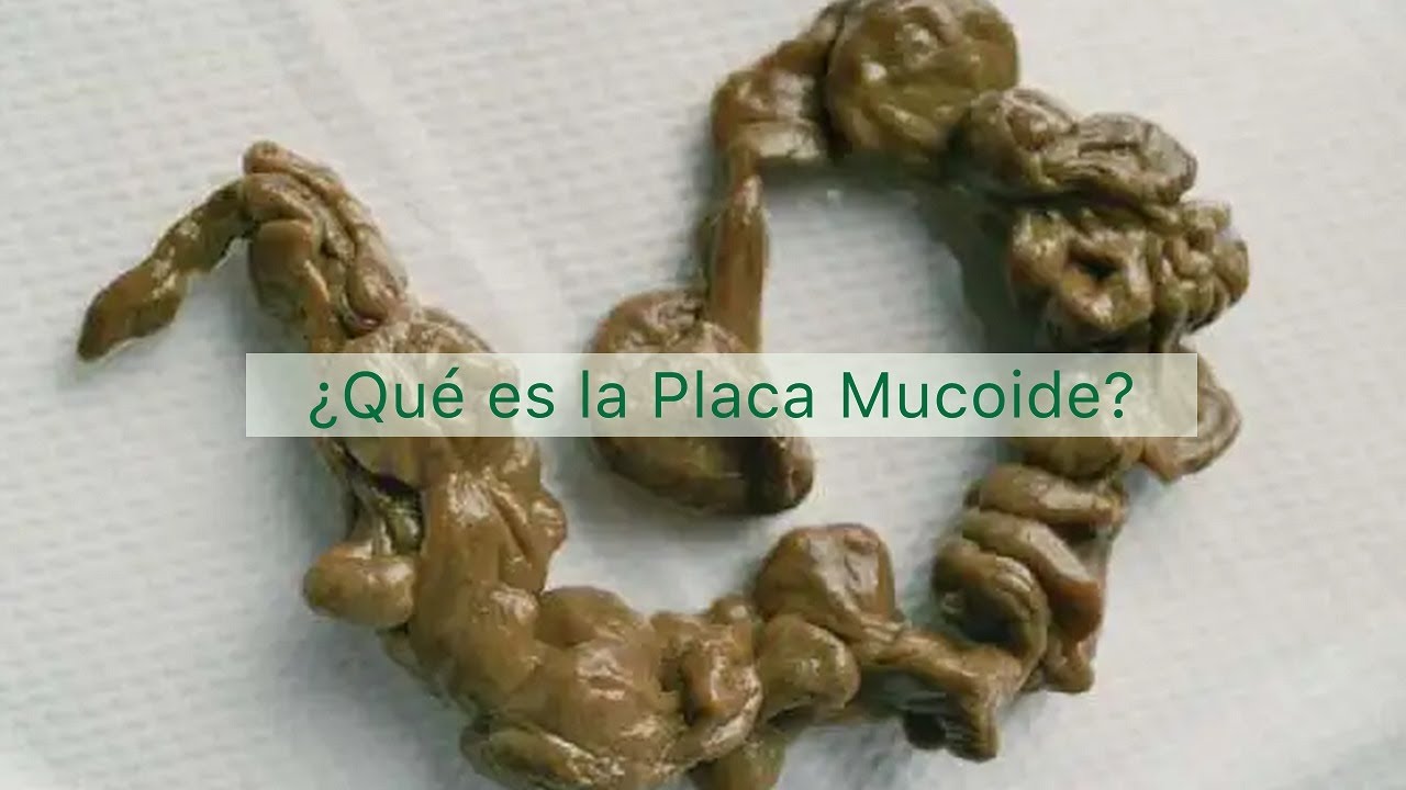 Eliminación de la Placa Mucoide - YouTube