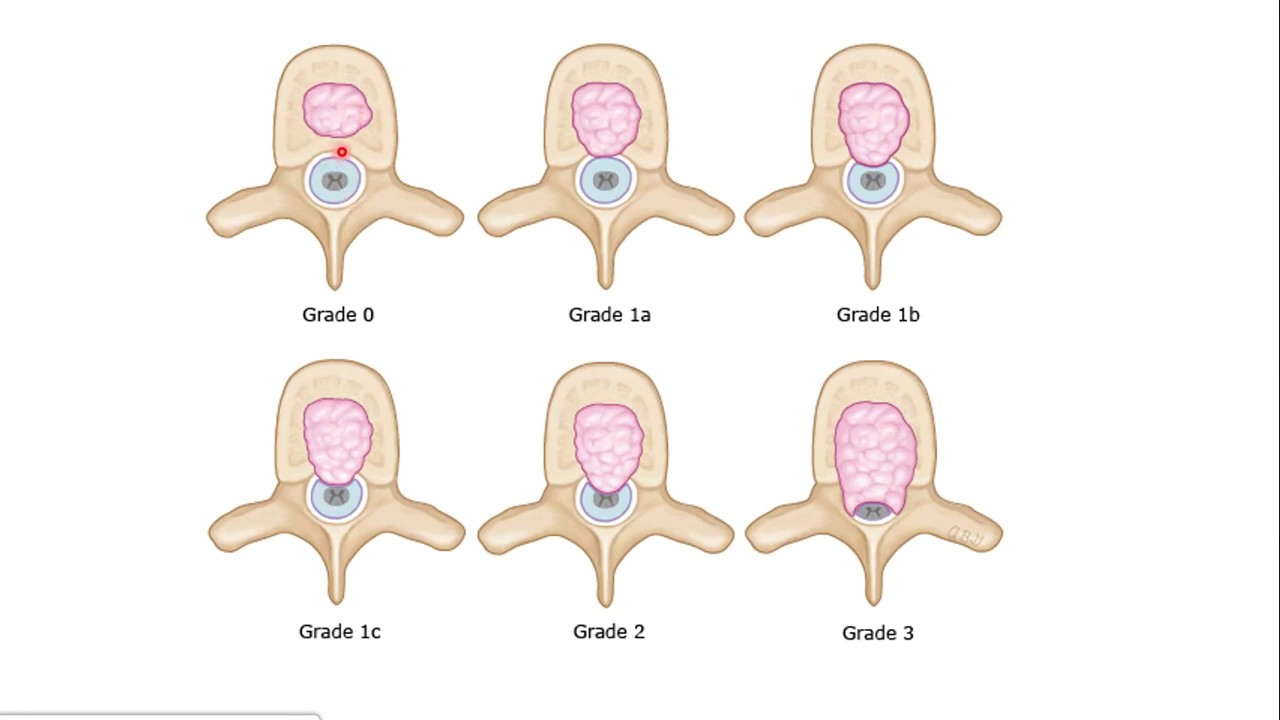 Síndrome de Compresión Medular Maligno - YouTube