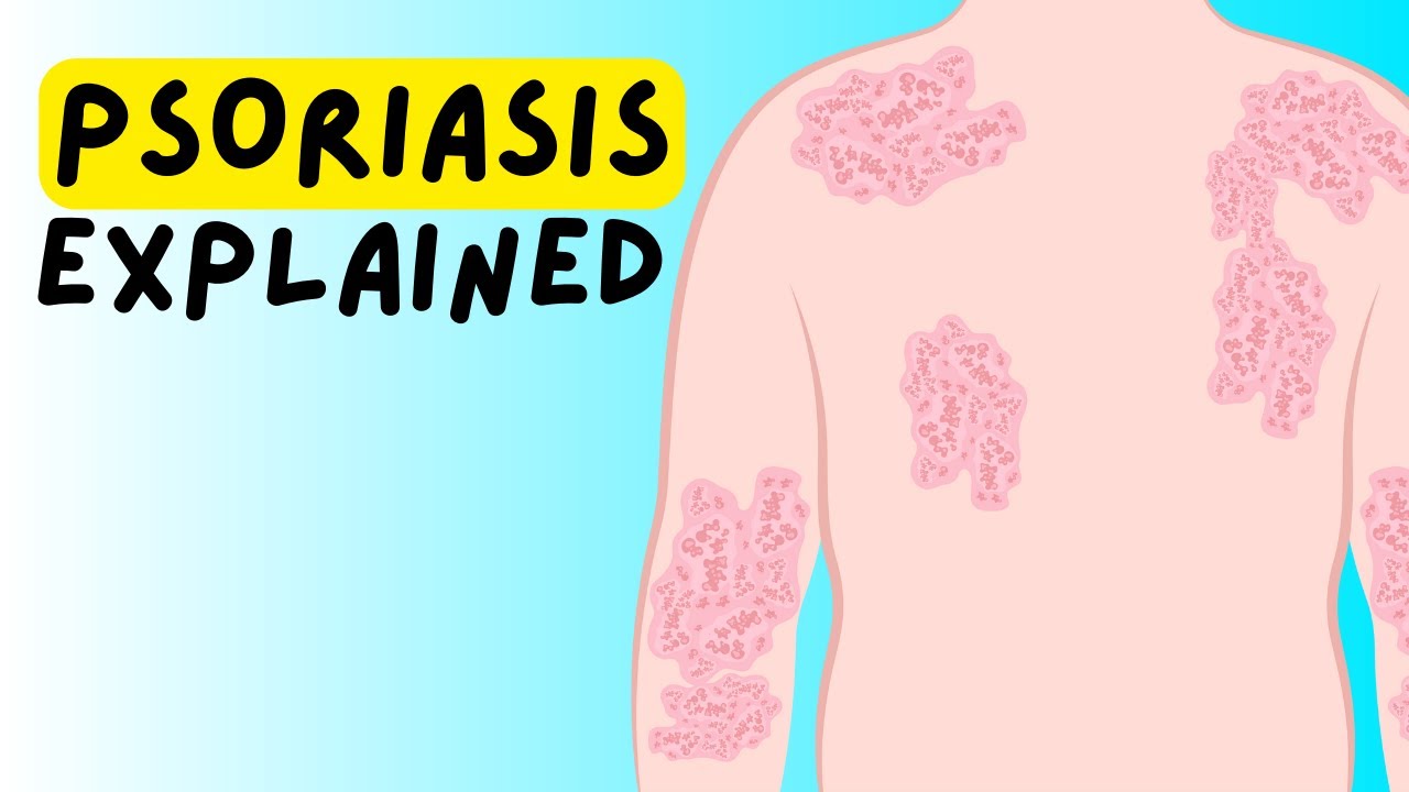 What is Psoriasis? Definition, Etiology, Classification ...