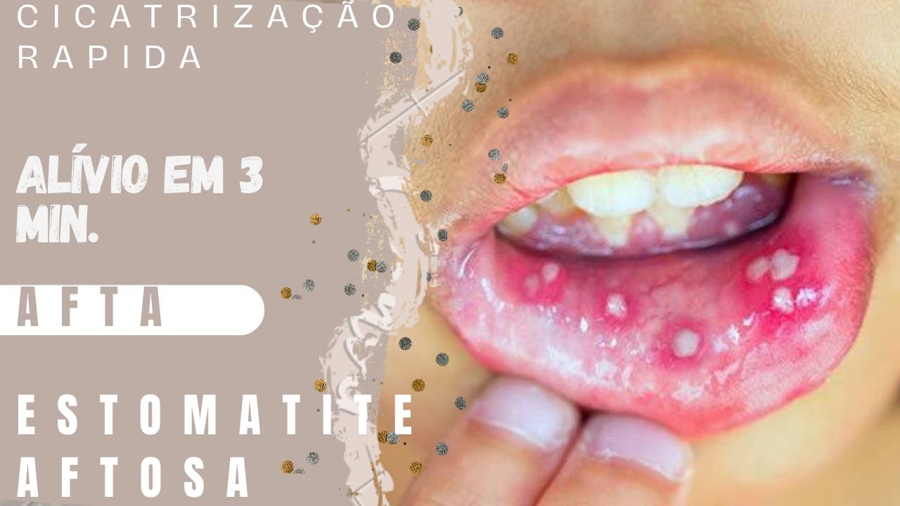 Pomada Mud Serve Para Afta Pomada Mud Serve Para Afta