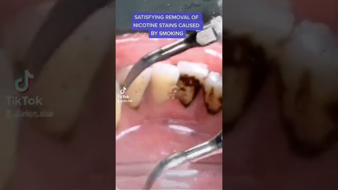 How to remove NICOTINE STAINS from your teeth. - YouTube