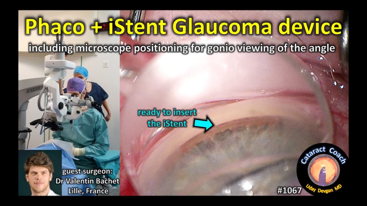 CataractCoach 1067: phaco with iStent glaucoma device implantation ...