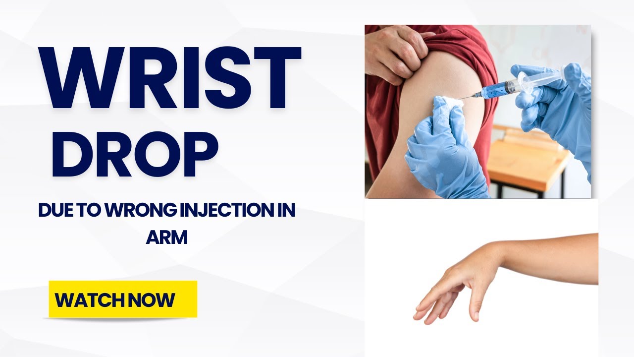 Wrist Drop | Causes of Wrist Drop | Wrist Drop Anatomy | Wrist Drop ...