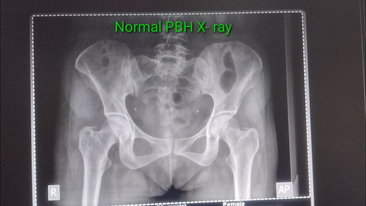 X-ray Pelvic Ap view - YouTube