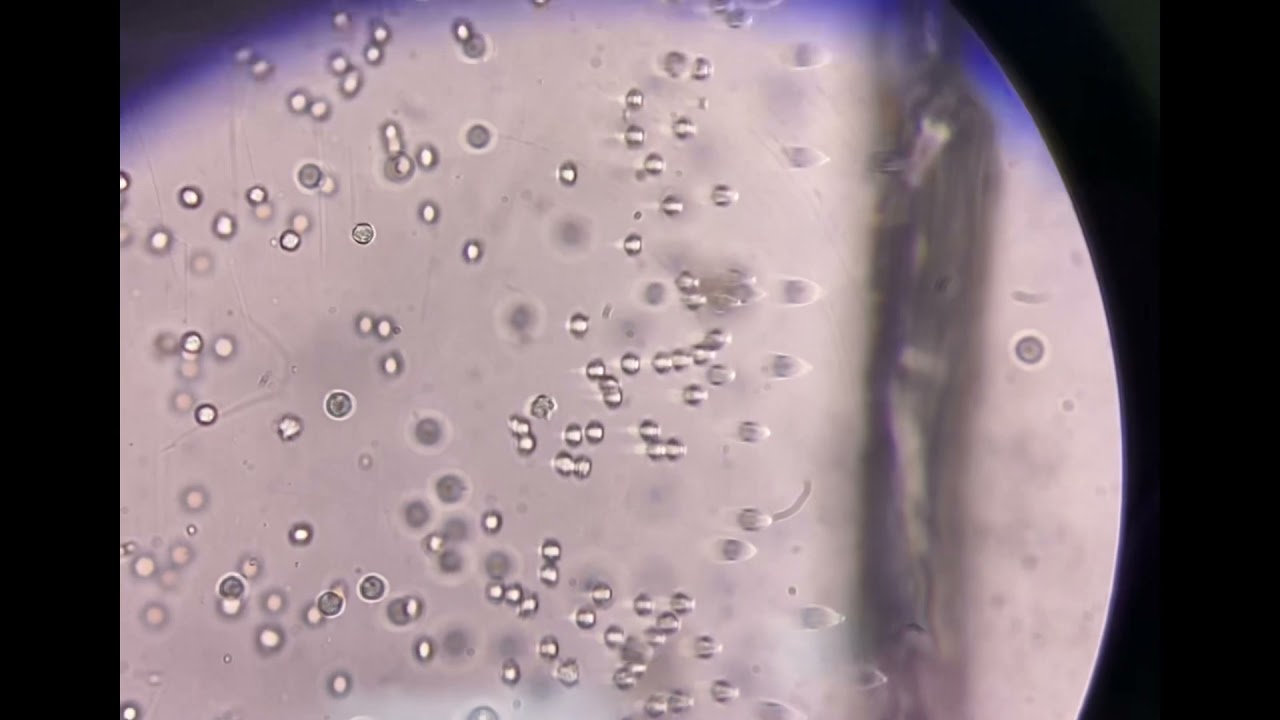 Synovial Fluid under conventional Light Microscope - YouTube