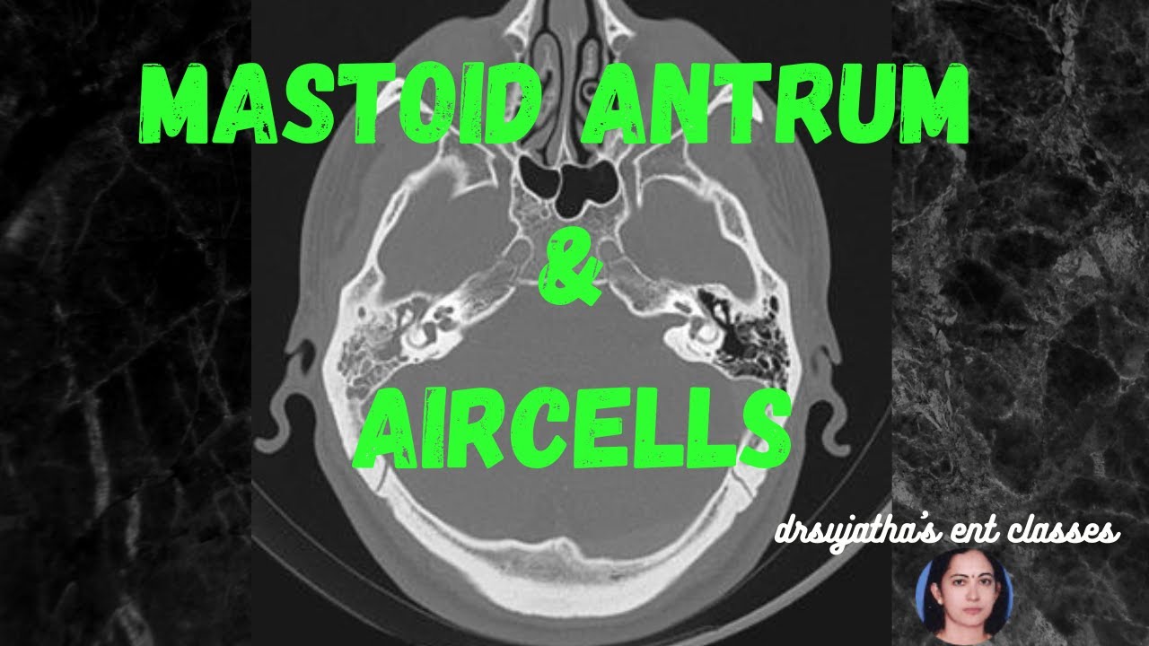 008. Mastoid antrum and air cells Anatomy #Anatomy mastoid aircells ...