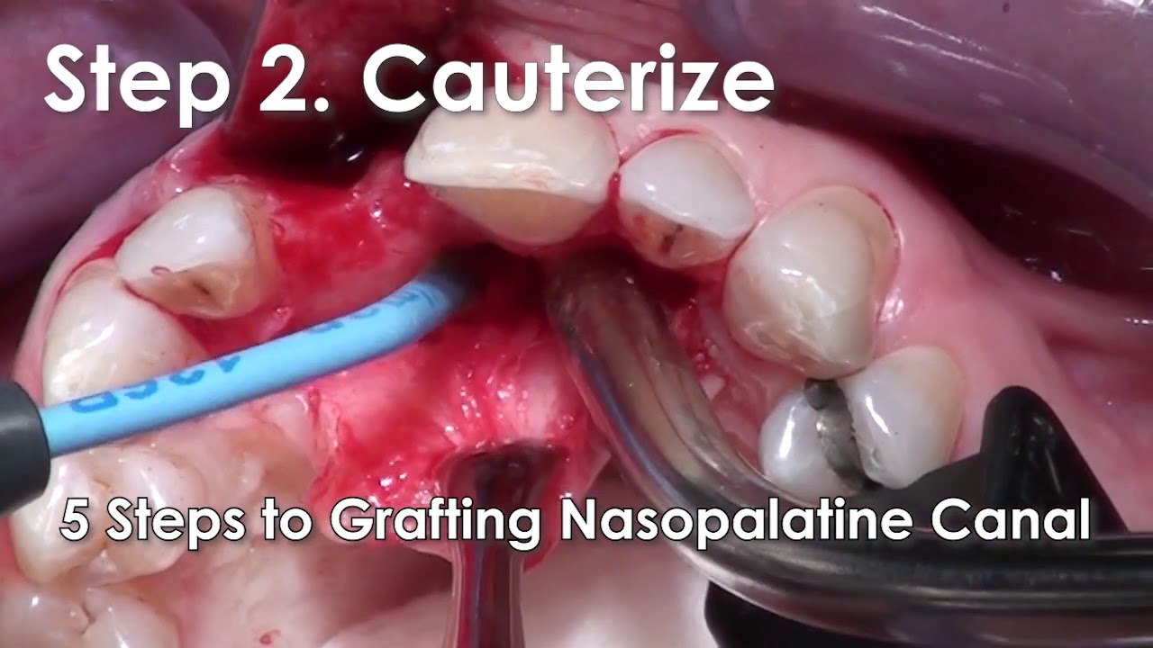 5 Easy Steps to Grafting the Nasopalatine Canal - YouTube