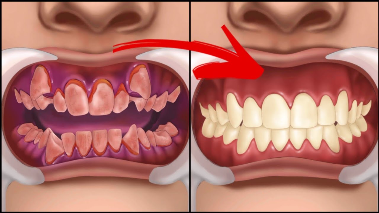 ASMR Teeth Amazing 😱 braces animation | Oddly Satisfying I Dentalcare ...
