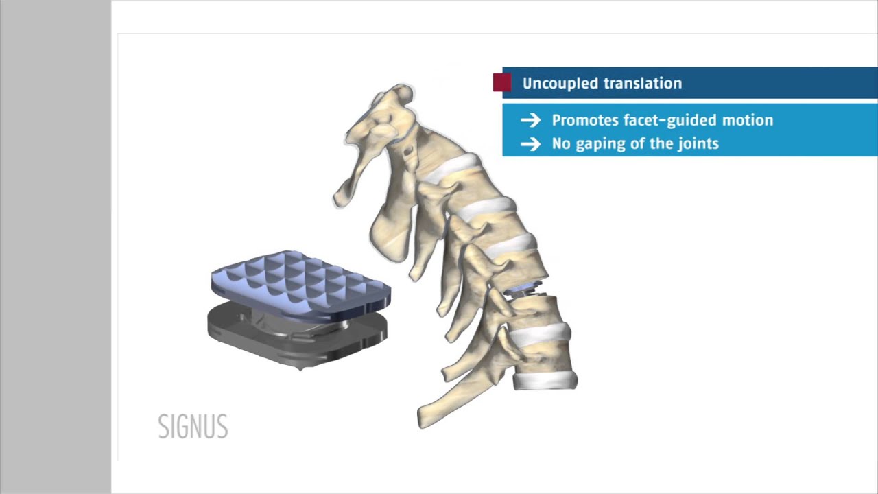 ROTAIO Cervical disc prosthesis - YouTube