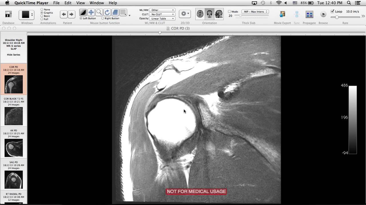 SLAP Tear - YouTube