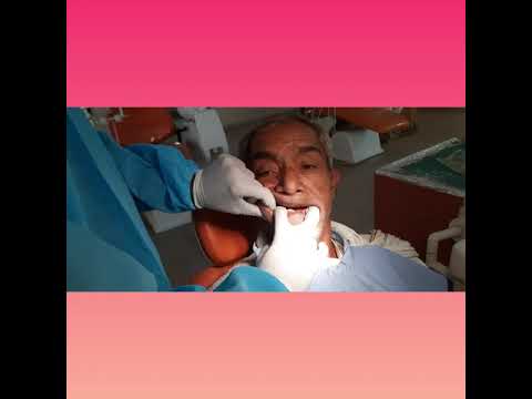 MULTISTEP/ SECTIONAL BORDER MOULDING AND FINAL IMPRESSION IN COMPLETE ...