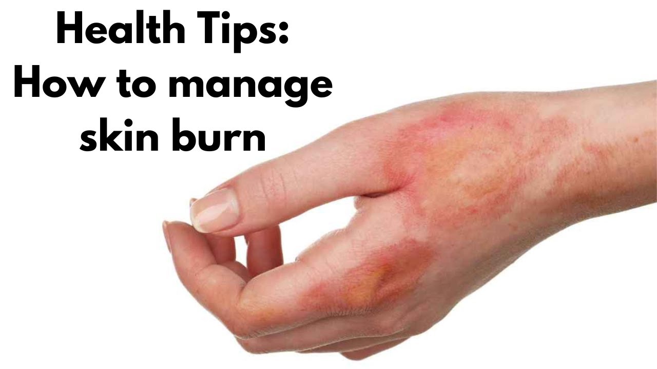 Skin burns? You can find helpful tips here. - YouTube
