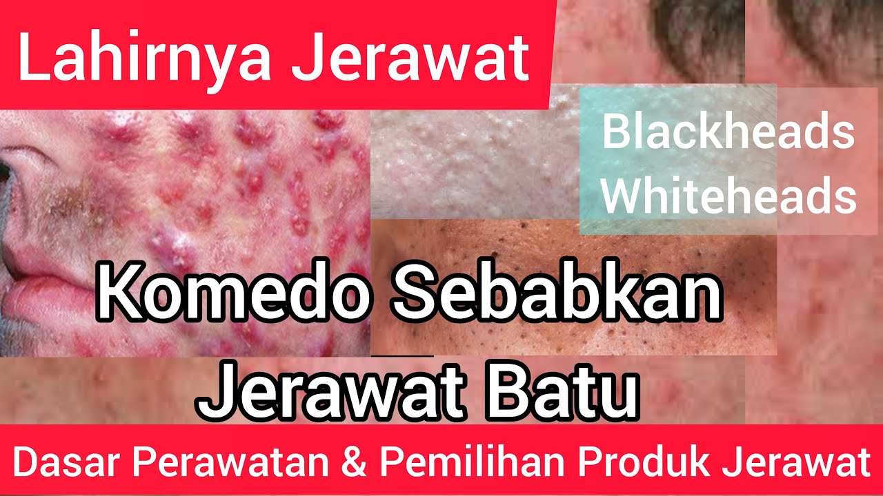 Mengatasi Jerawat Batu, Komedo, Papul, Pustul, & Nodul || AHA, BHA, PHA ...