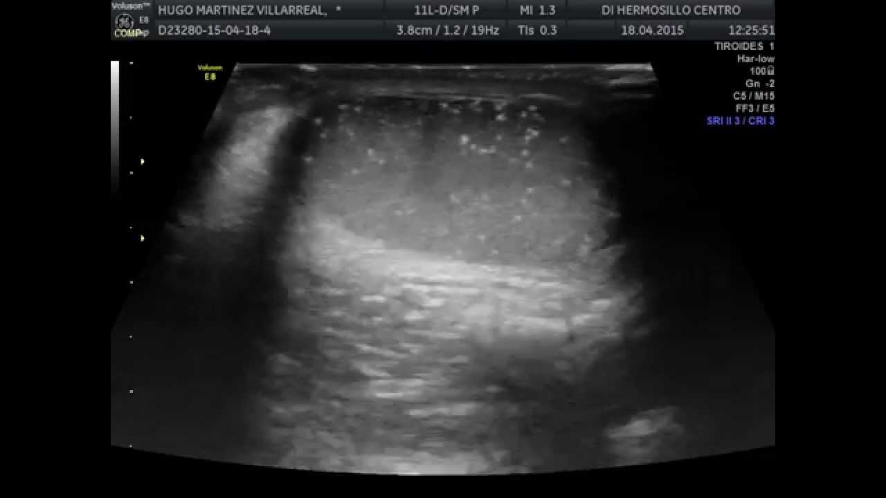 microlitiasis testicular - YouTube