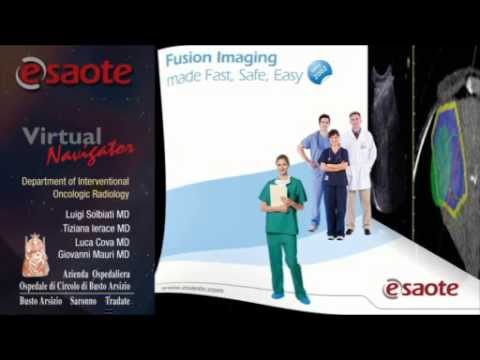 Experience ESAOTE Virtual Navigator fusion imaging (TRAILER) - YouTube