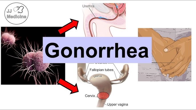Gonorrhea Female