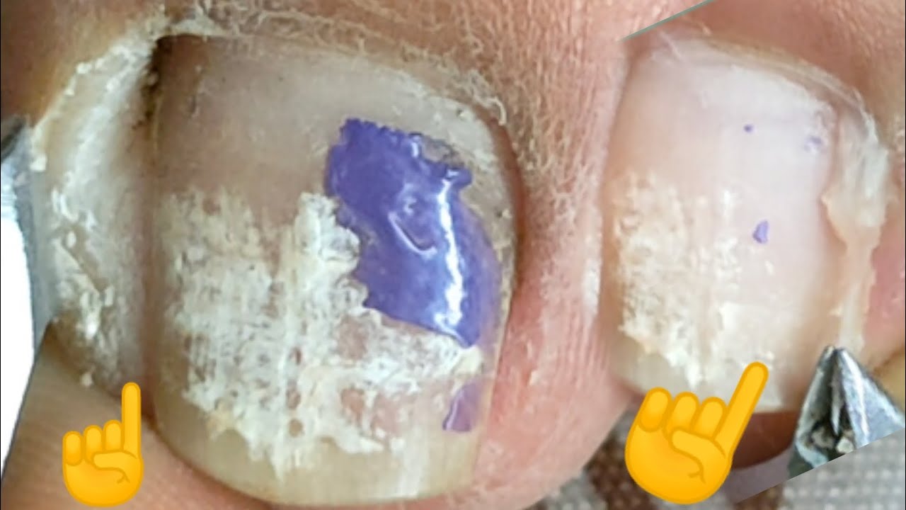 Parang bulati ang ingrown na hinila - YouTube