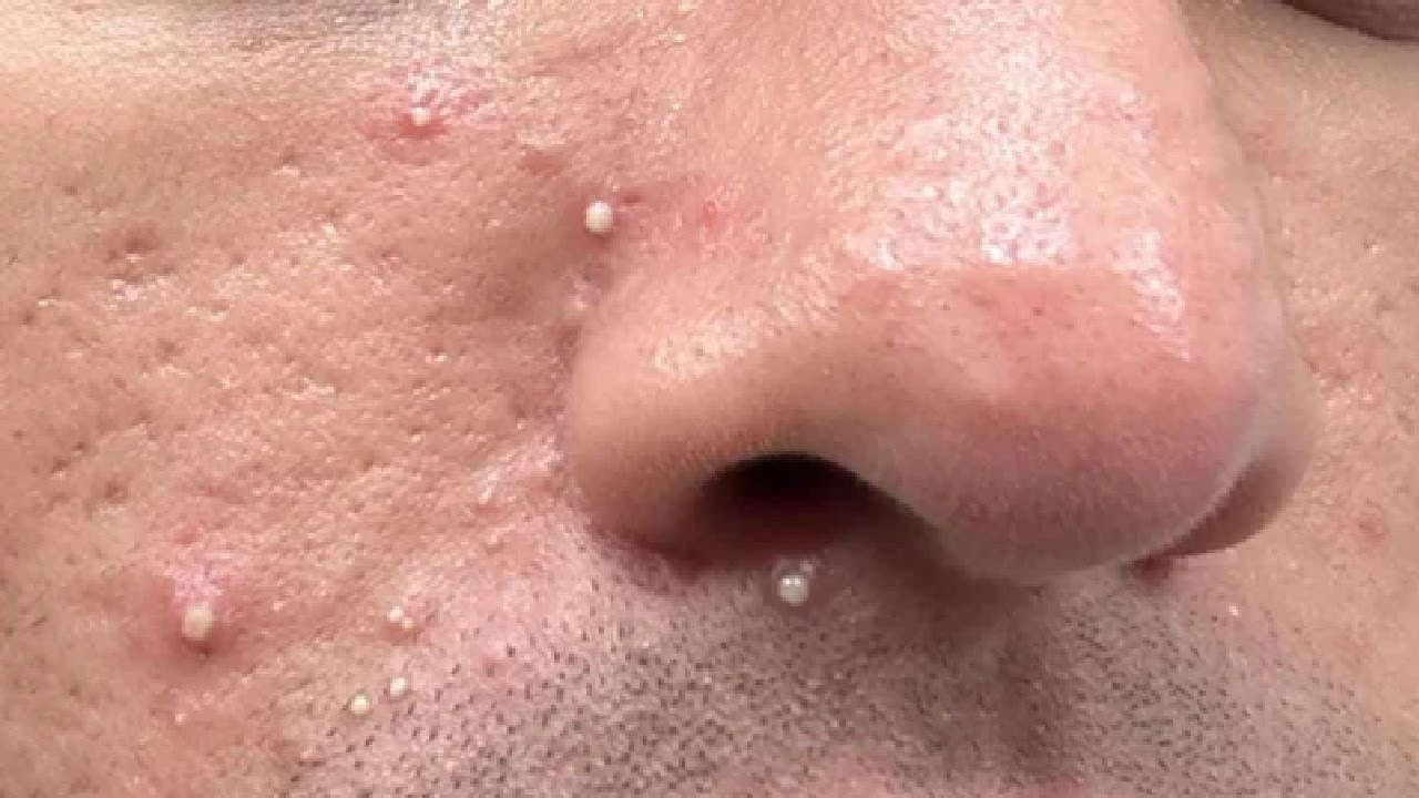 HOW TO REMOVE WHITEHEADS AT HOME INSTANTLY - YouTube