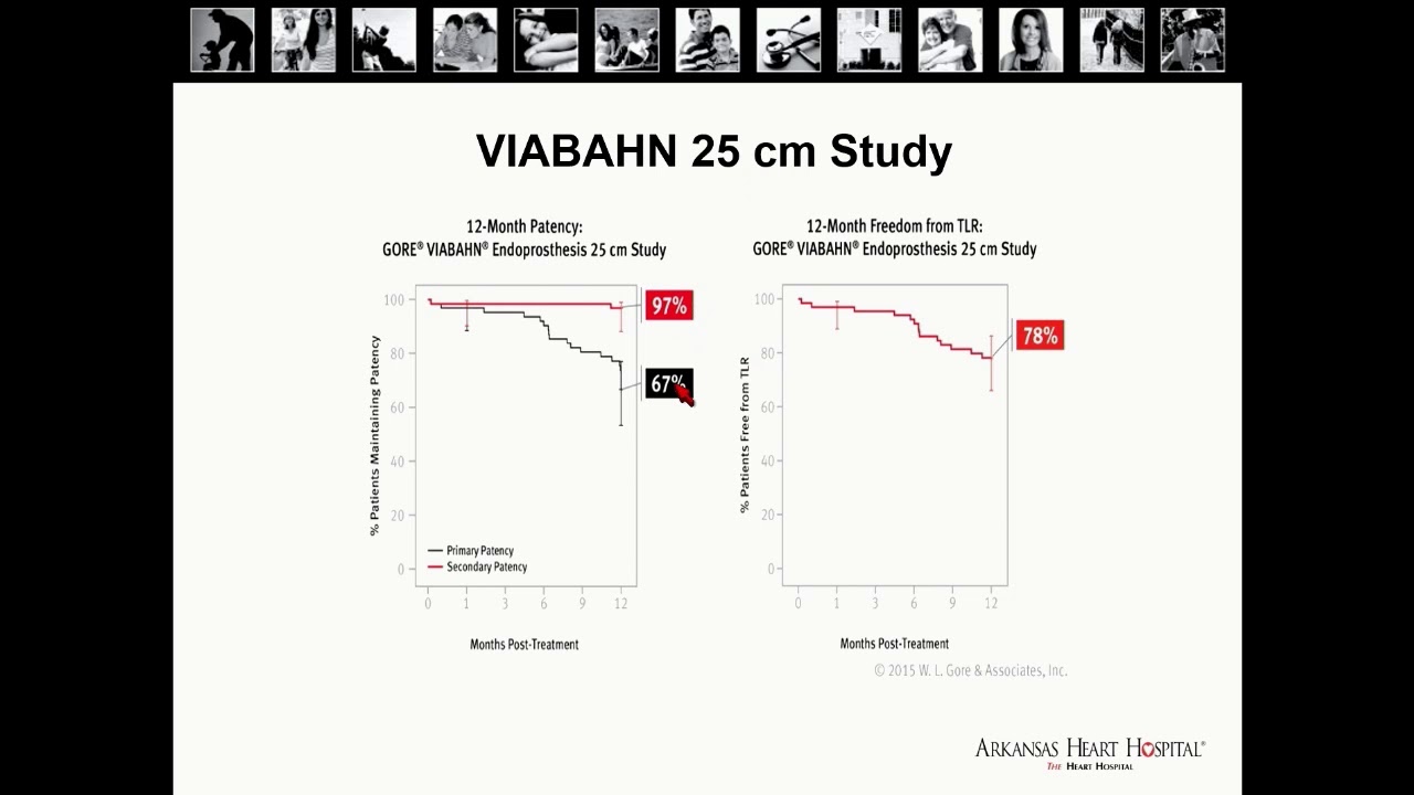 Viabahn, When and Why? - Ian Cawich, MD - YouTube