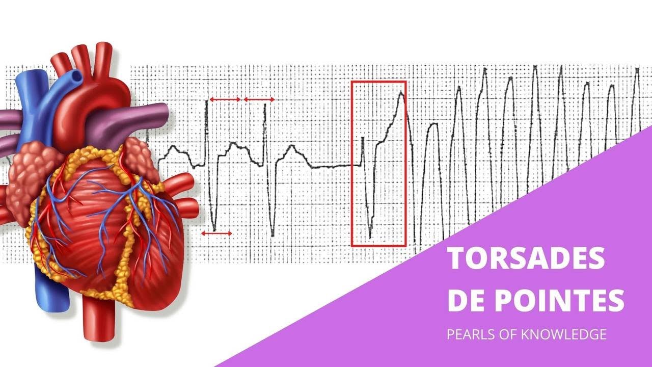 Torsades de pointes life threatening type of irregular heart rhythm ...