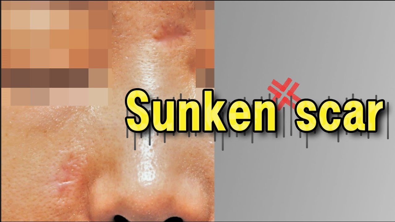 A patient who got a sunken scar in the middle of a hospital treatment ...