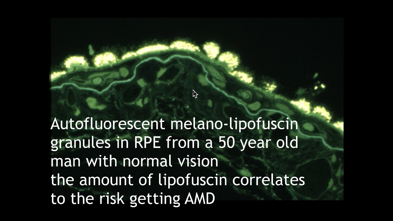 Why is lipofuscin in the retinal pigment epithelium toxic? - YouTube