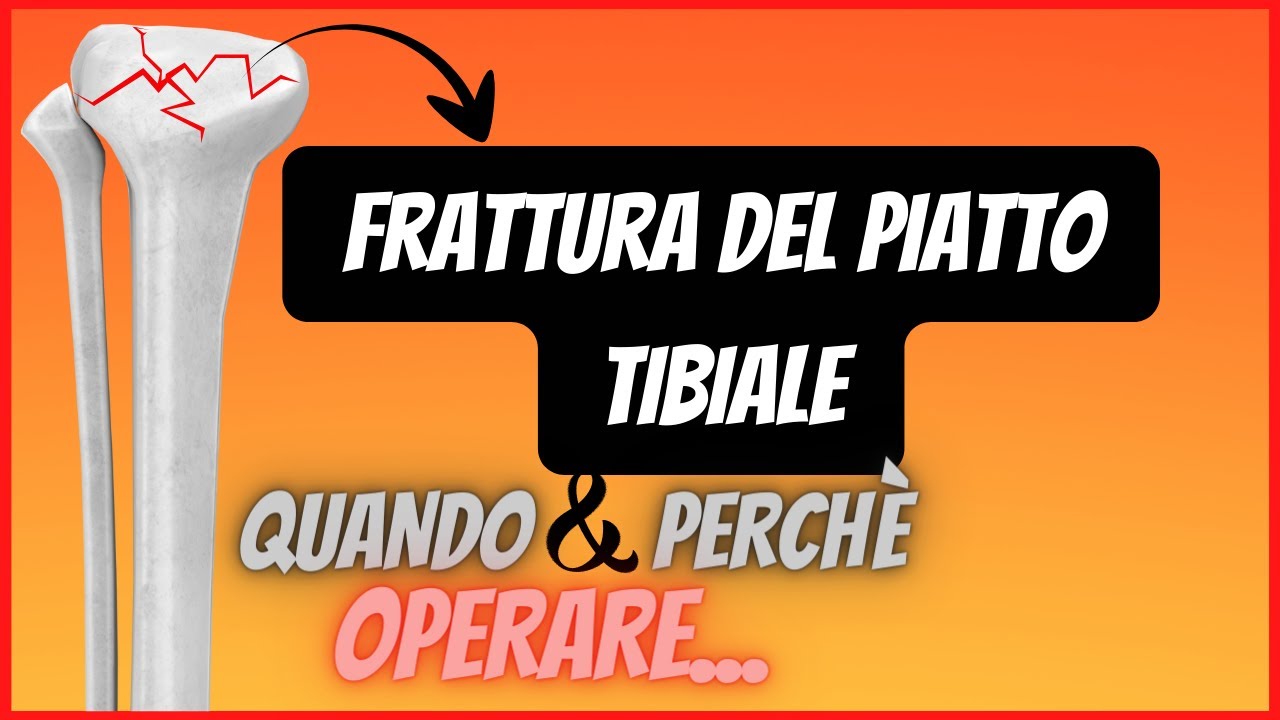 Frattura del Piatto Tibiale - Perchè è necessario l'intervento ...