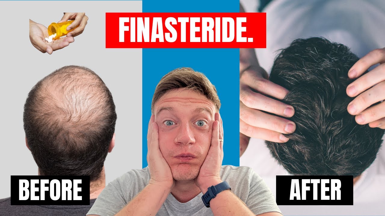 PEOPLE GOT THESE RESULTS WITH FINASTERIDE ALONE?! | REVIEW - YouTube