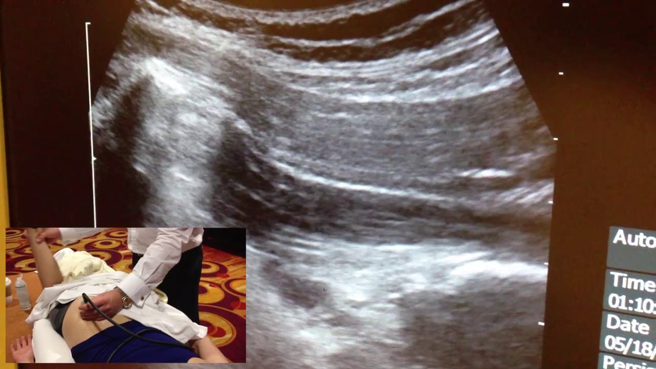 Ultrasound Guided Piriformis Injection - YouTube