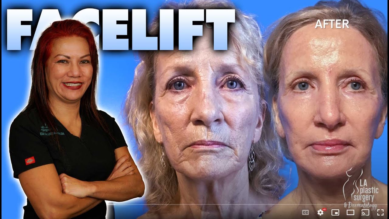FACELIFT - 74 Year Old Patient - Face, Neck, Skin Resurfacing - YouTube
