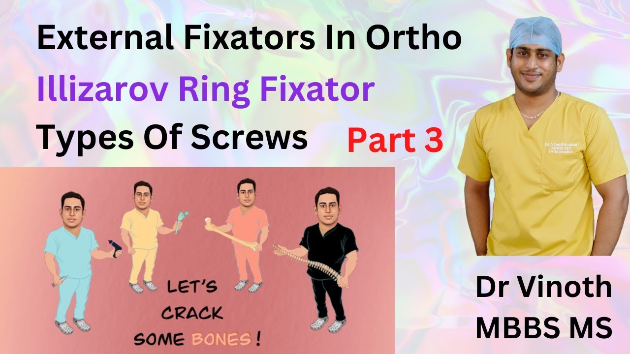 External fixators in Orthopaedics| Illizarov fixator | Rail fixator ...