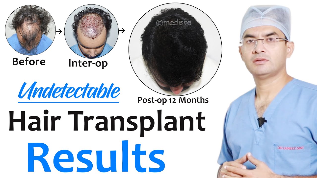 Best Hair Transplant In India Results Fut Fue Bht Prp Medispa