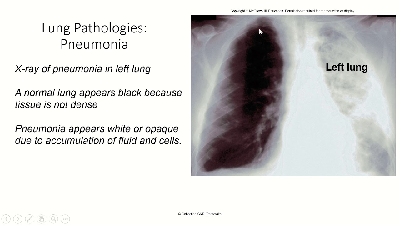 Ch25 Pt8, Respiratory System, Lung Histology and Pathologies - YouTube