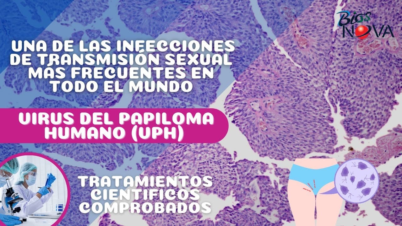 Virus del Papiloma Humano VPH / Una de las infecciones de transmisión ...