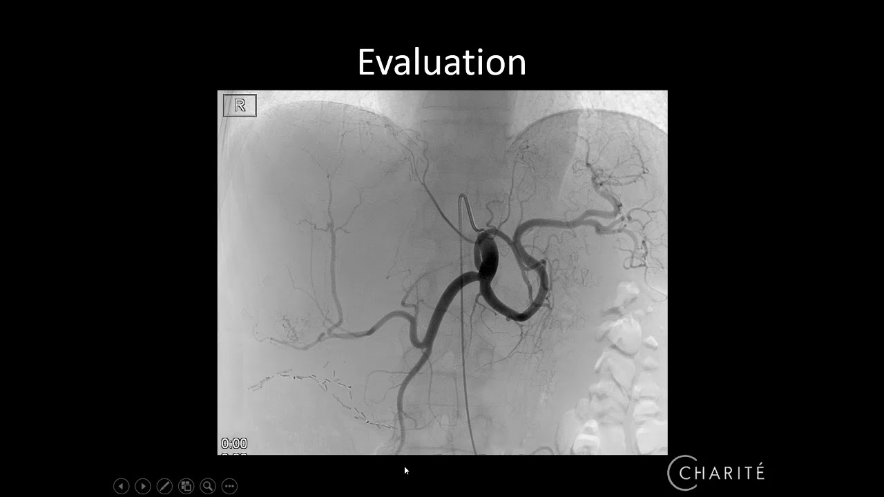 Transarterial radioembolization to treat primary or secondary liver ...
