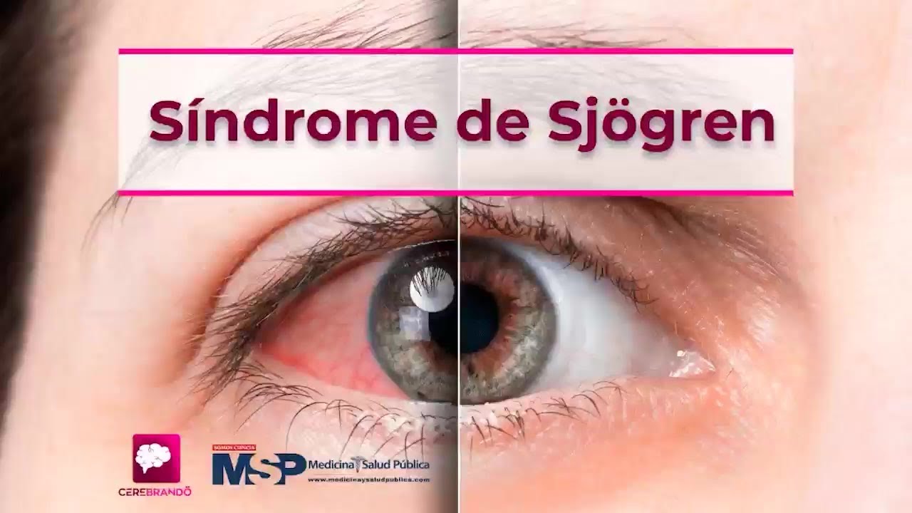 Síndrome de Sjögren - YouTube