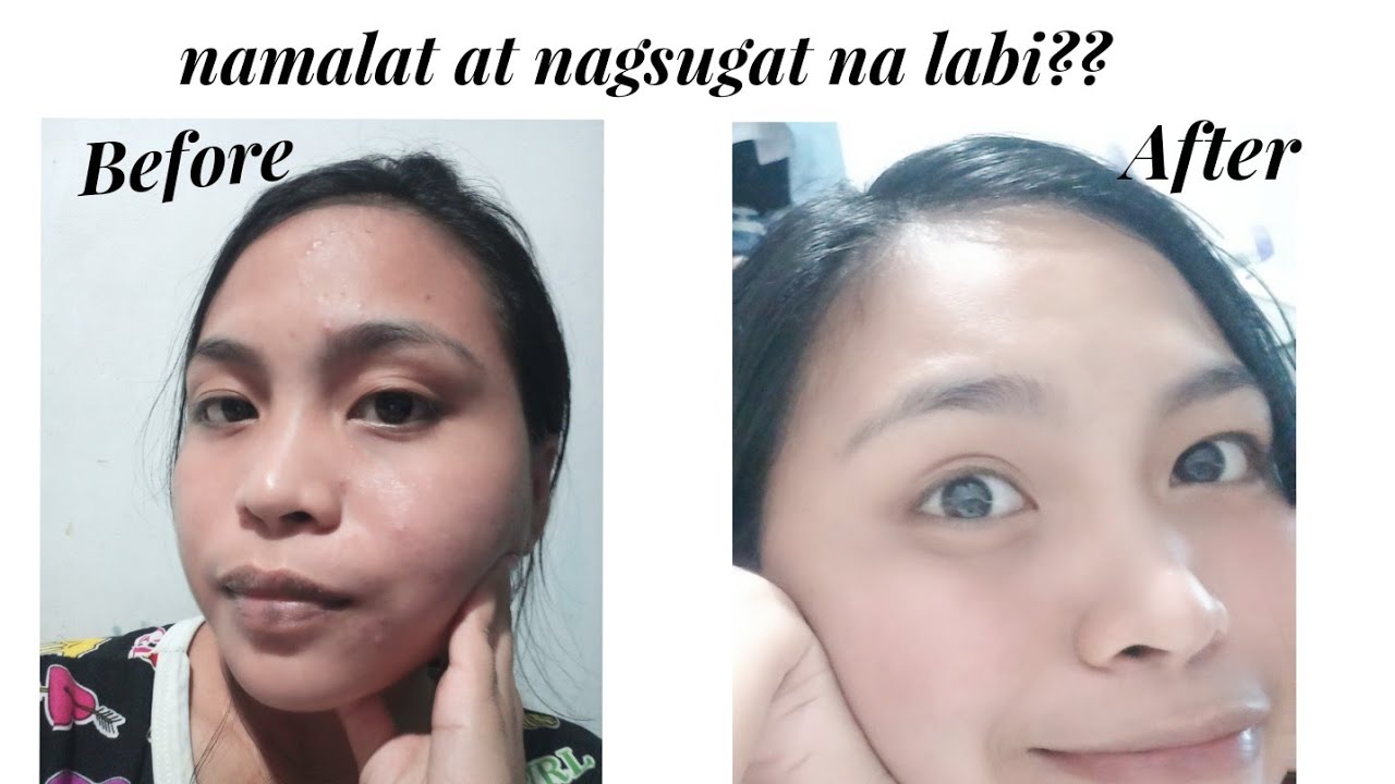 namamalat at nagsusugat na labi!!alamin ang gamutan at dahilan nito!!!🤔 ...