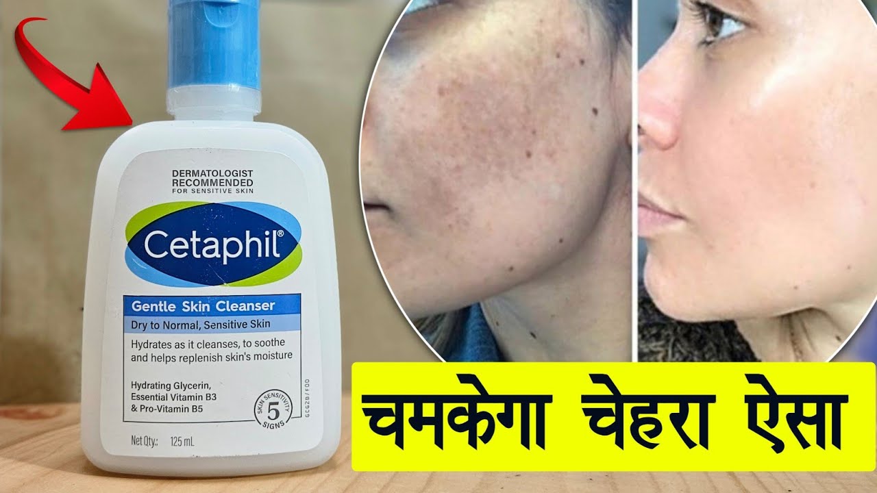 Cetaphil cleanser | Miracle benefit | Uses, benefits, Side effects ...