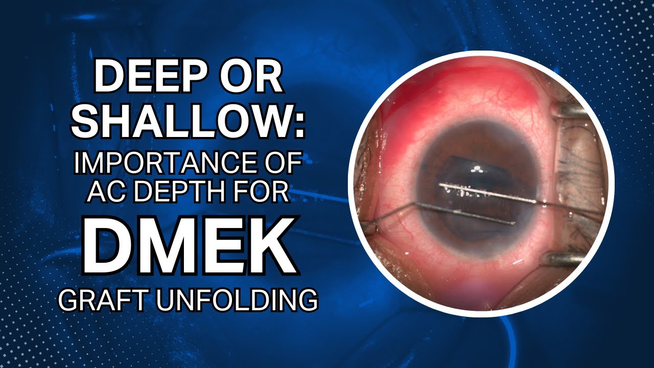Deep or Shallow: Importance of AC Depth for DMEK Graft Unfolding - YouTube