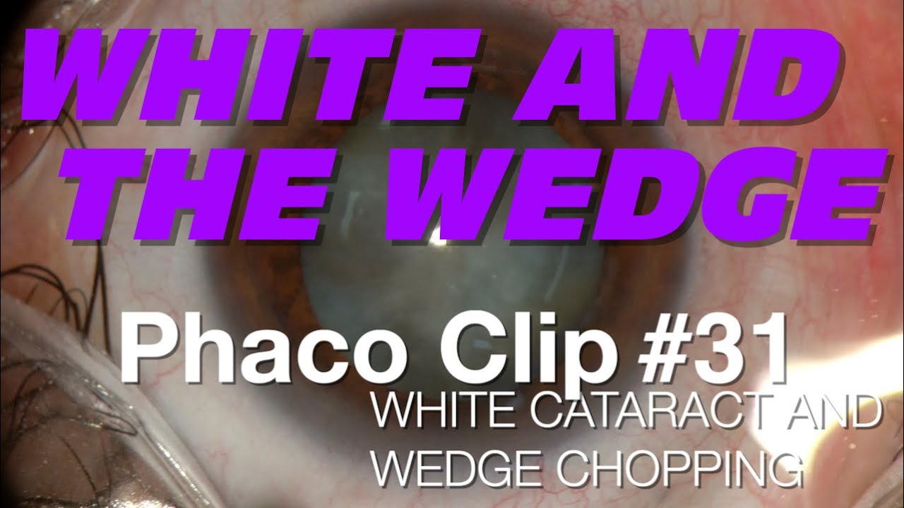 Phaco Clip #31 - White Cataract and Wedge Chopping - YouTube