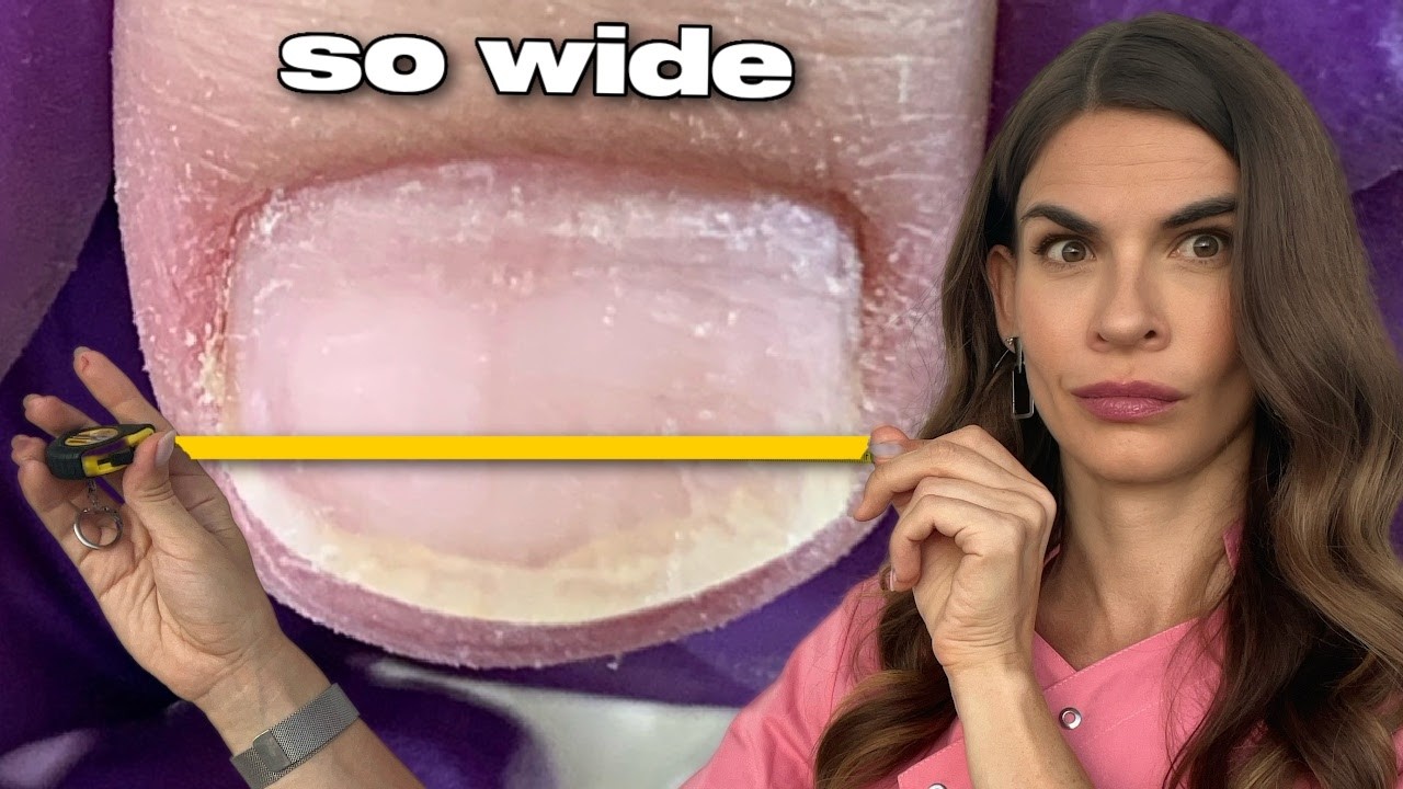 Ultra Wide Thumb Transformation Tutorial with Dual Forms - YouTube