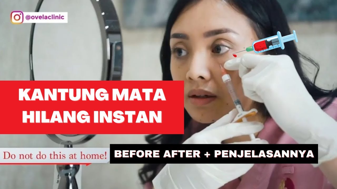 Filler Kantung Mata Before and After (Suntik Sendiri ???) - Ovela ...