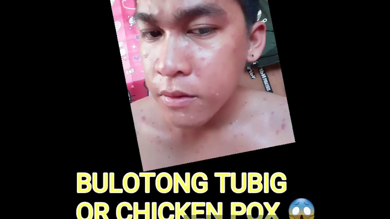 Chicken Pox or Bulotong Tubig - My Experience sa PASKO 2019 😭 - YouTube