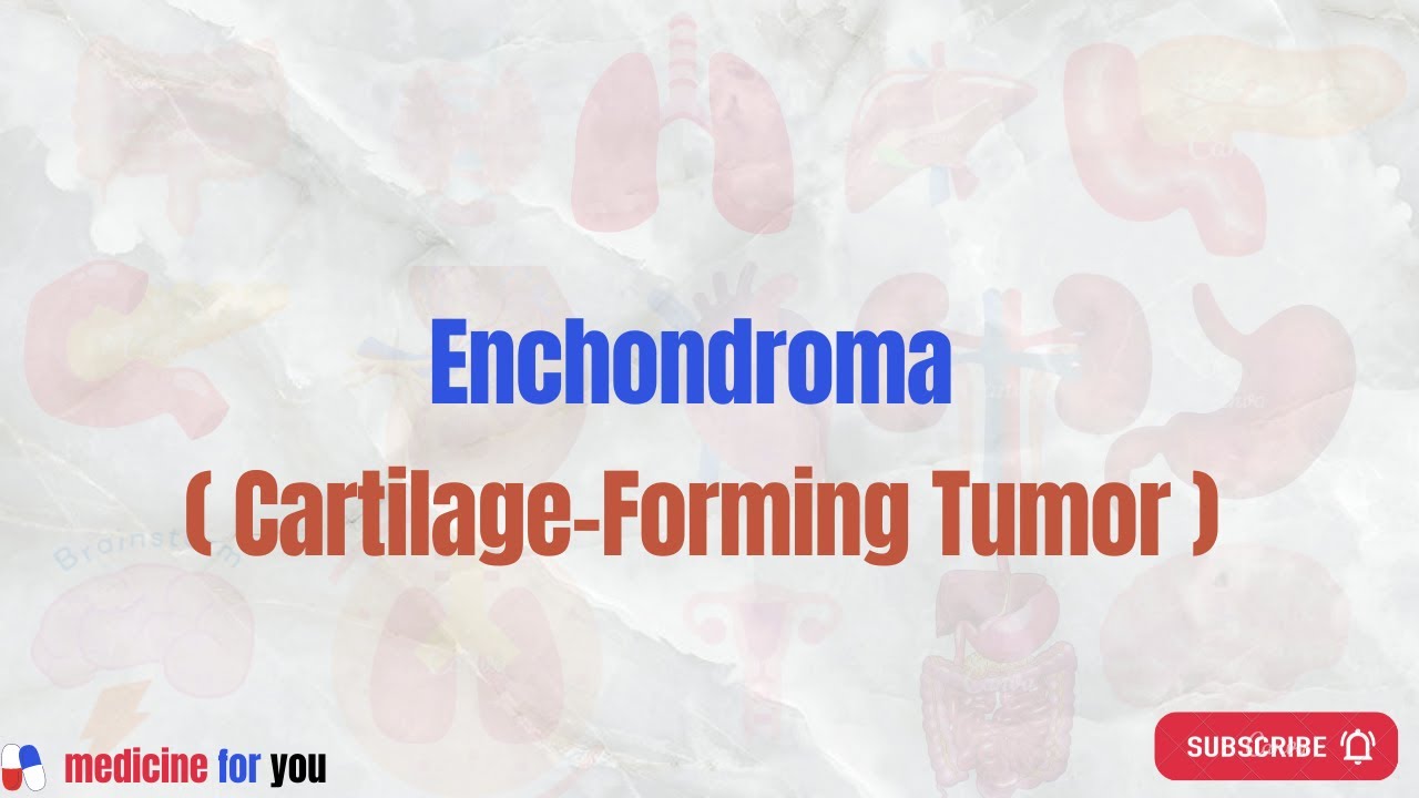 Enchondroma ( Cartilage-Forming Tumor ) - YouTube