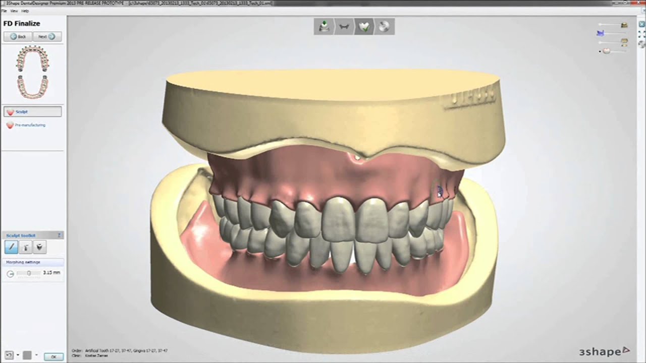 Dental System 2013 - Prothèse Complète / 3shape Dental System Full ...